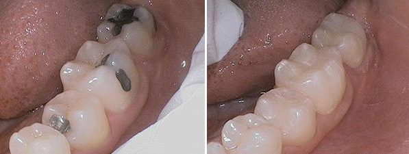 Tooth Fillings Before & After | Barrera Advanced Dentistry Smile ...